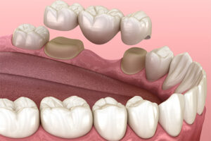 Understanding the 4 Types of Dental Bridges - Doctor Smiles Orthodontics